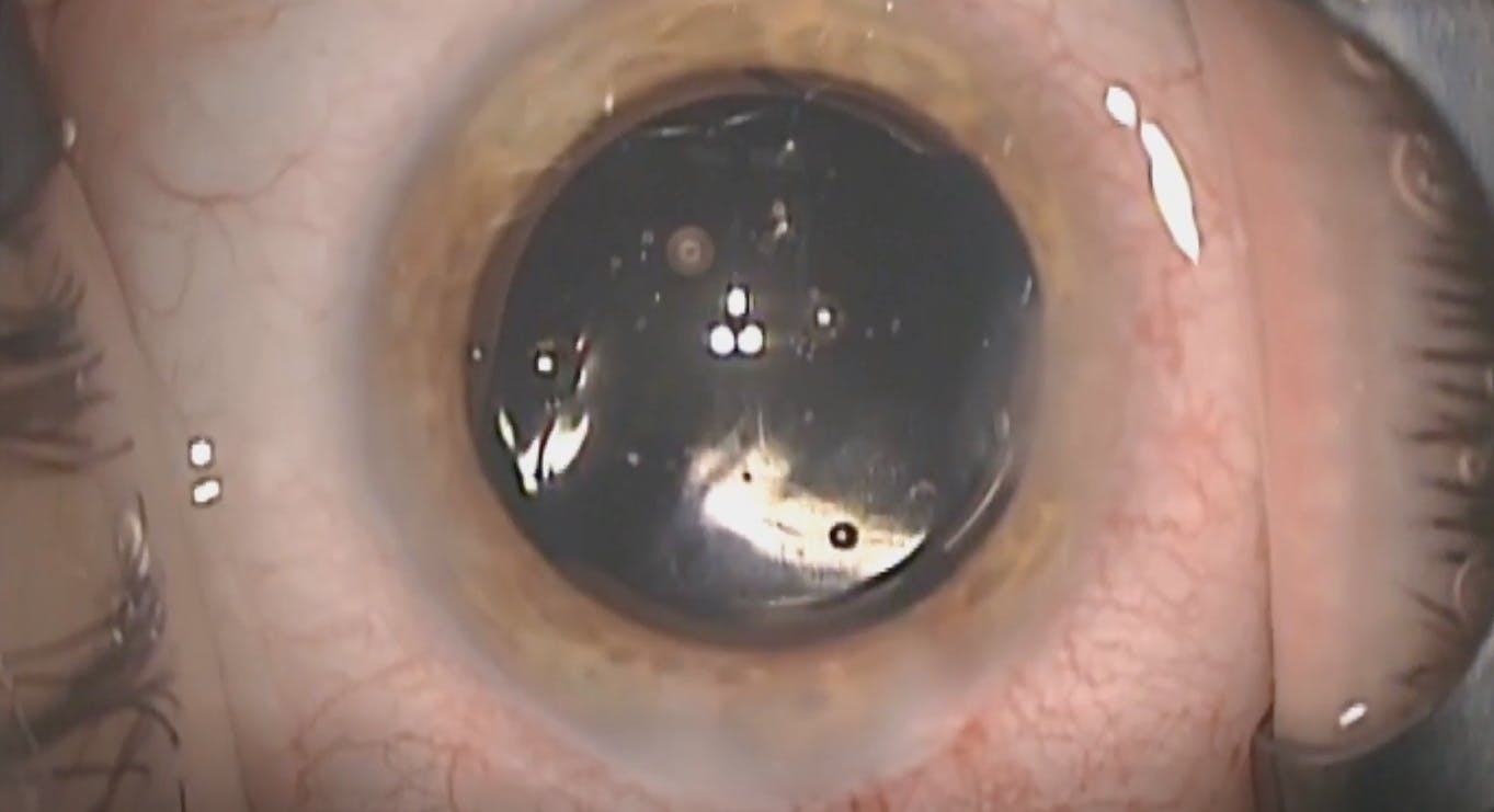 Black AddOn IOL - Eyetube