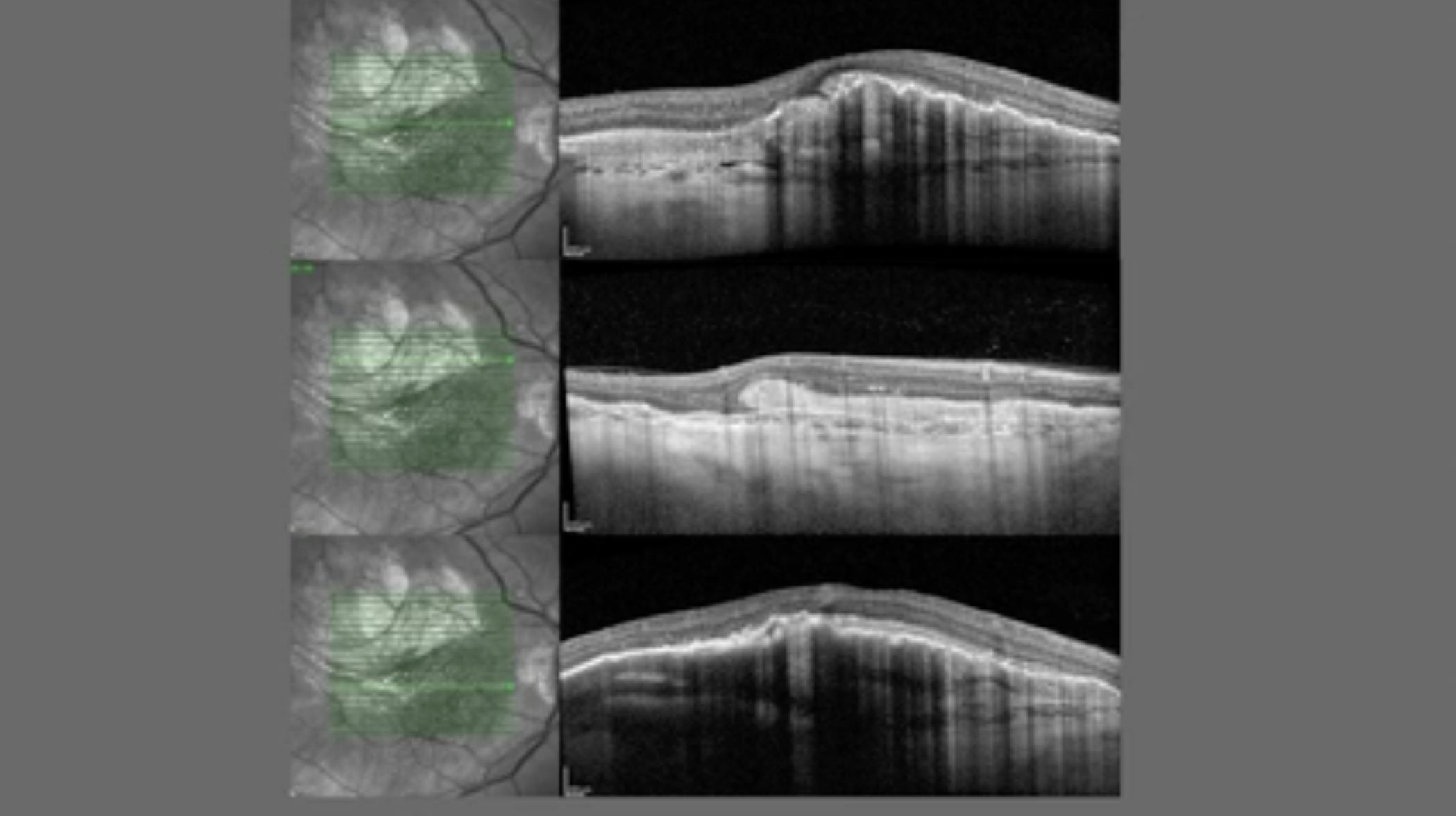 Switch Case: Massive PED (Part 2) - Eyetube