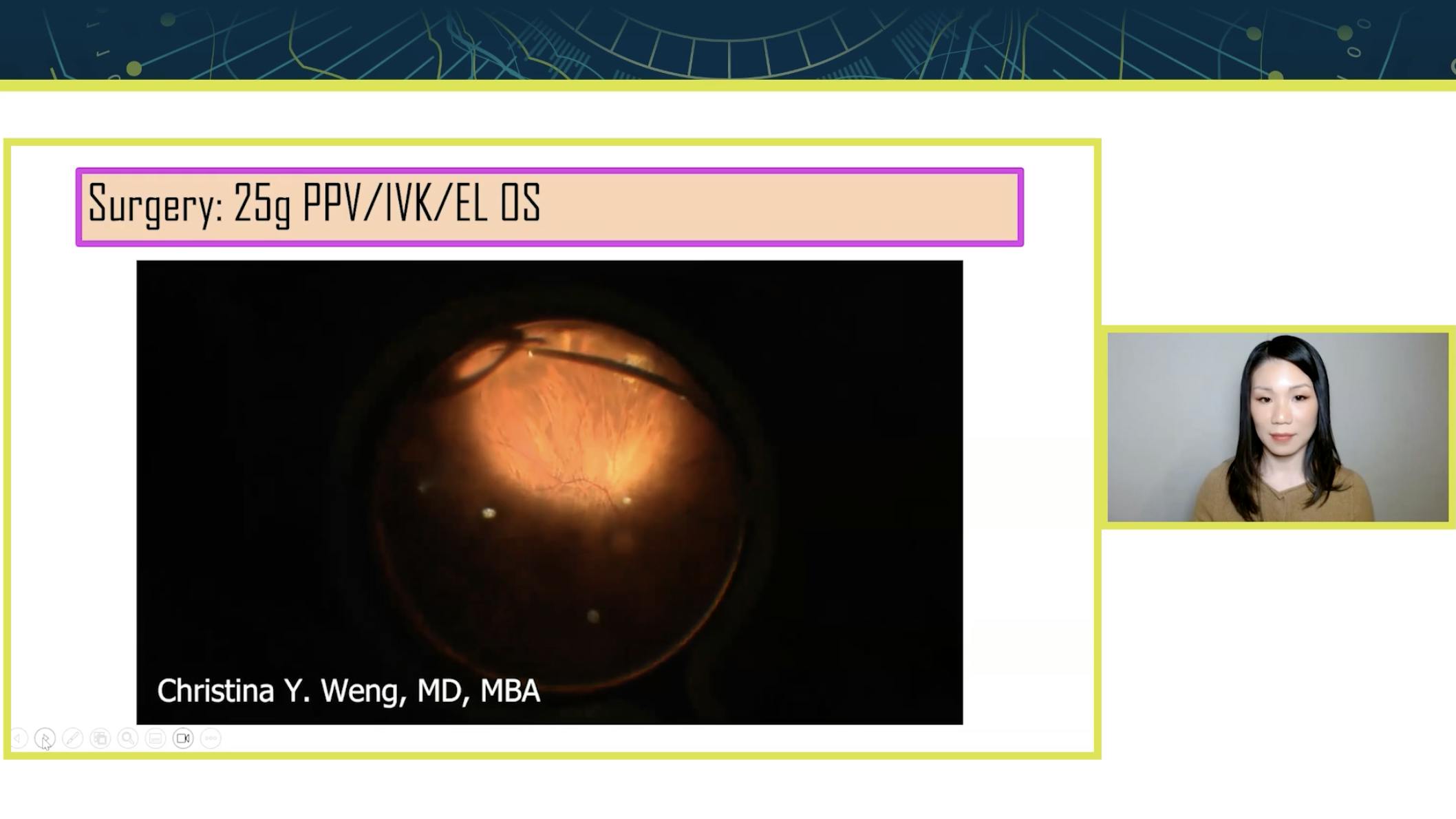 Surgery for Vitreous Opacities in an Eye With MFIOL, Previous History ...