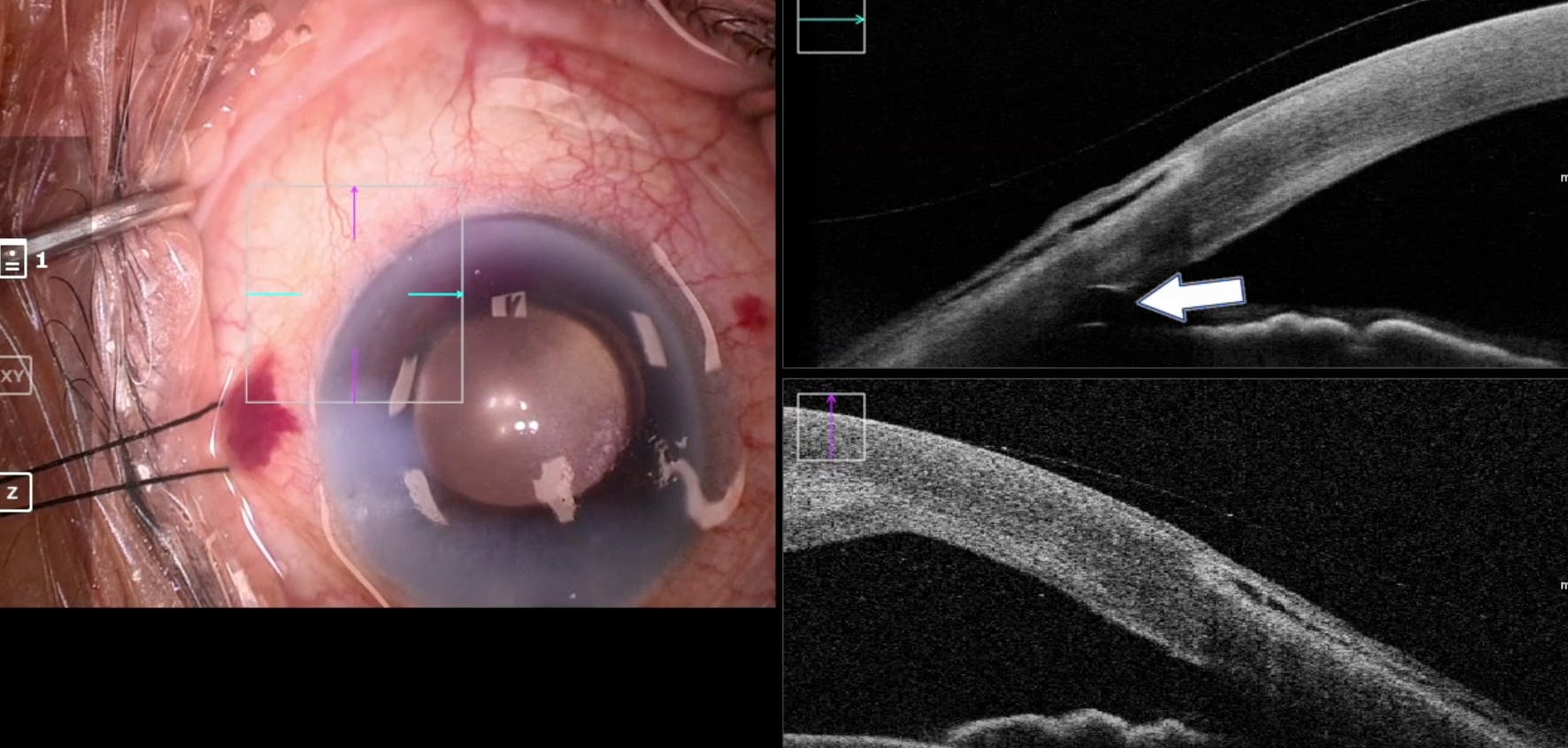 Hydrus Microstent Implantation With Intraoperative OCT - Eyetube