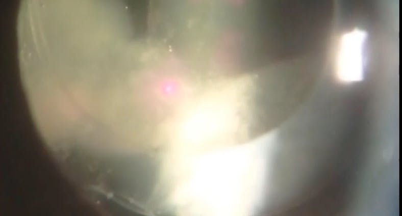 Rare Case of Retrolenticular Pseudohypopyon - Eyetube