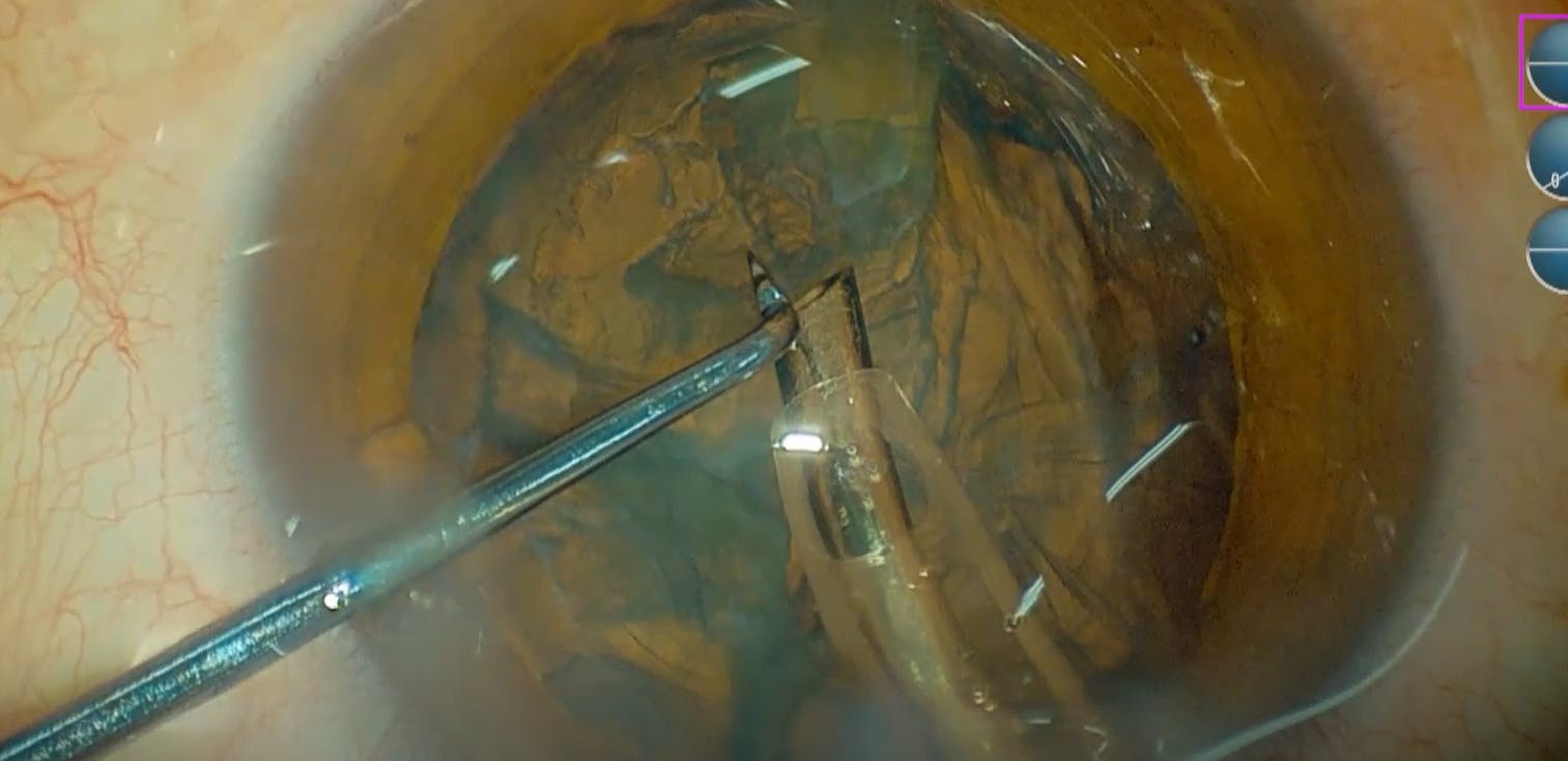 Optimal IOP for the Stable Anterior Chamber - Eyetube