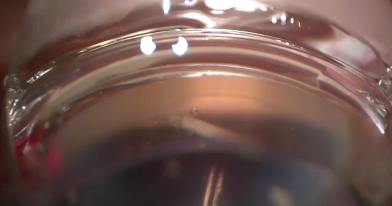 iTrack Canaloplasty With 90° Goniotomy - Eyetube