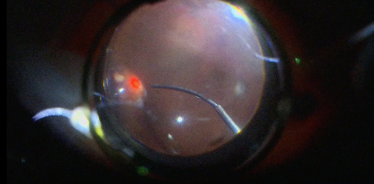 Magic Scleral Buckling - Eyetube