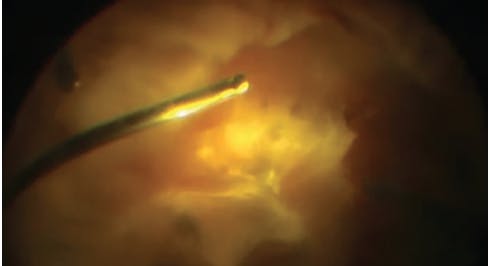 Complicated DR Cases: The Second Surgery - Retina Today