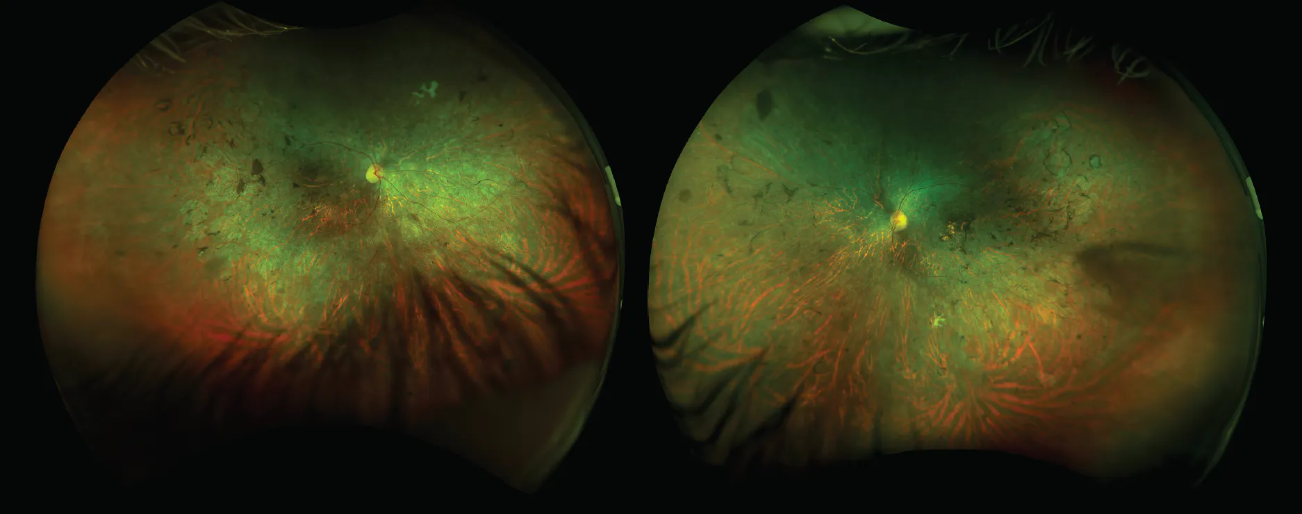 A Complicated Case of Ocular Tuberculosis - Retina Today