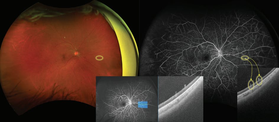 The Value of Multimodal Imaging in the Retina Clinic - Retina Today