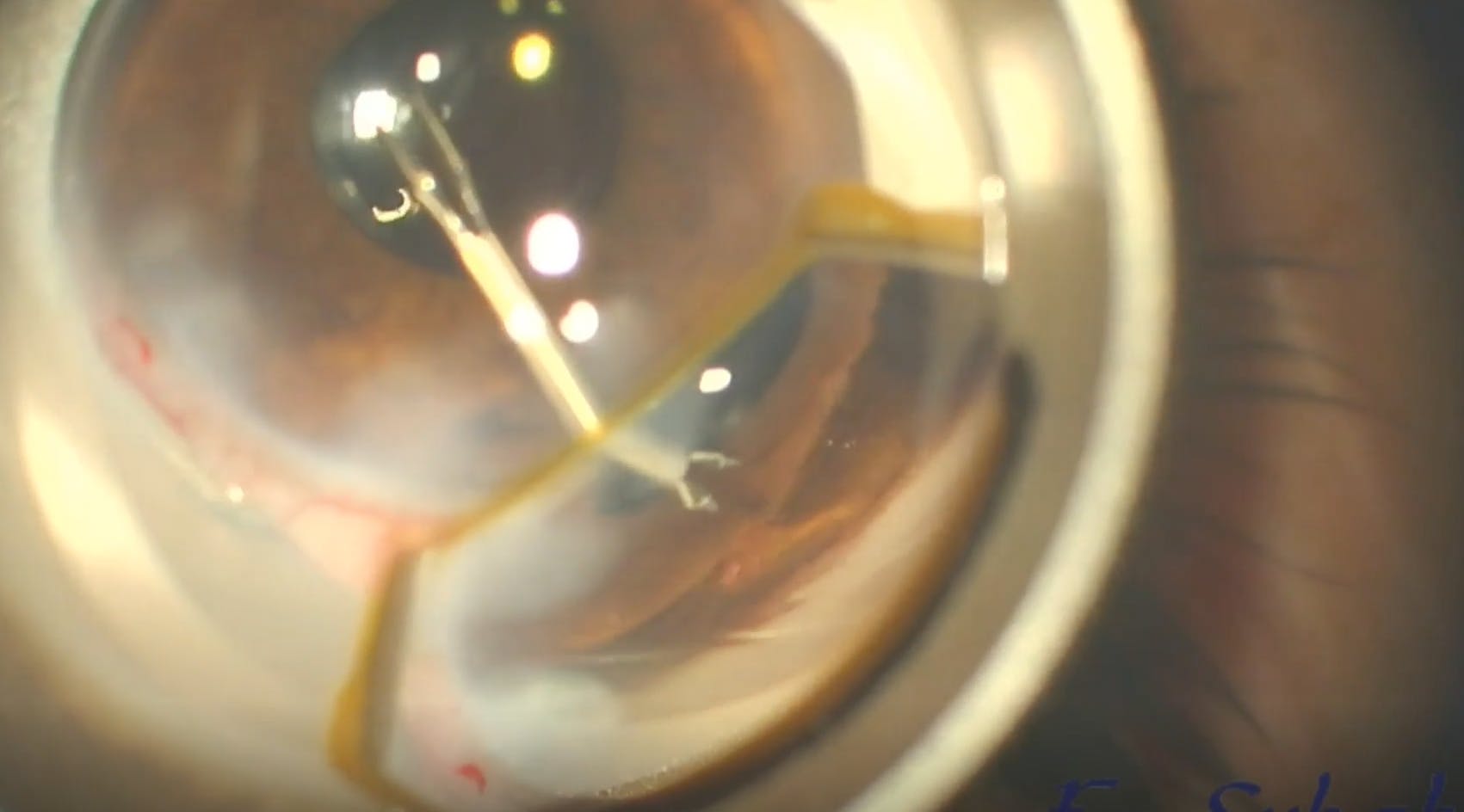 Nanophthalmos - Eyetube