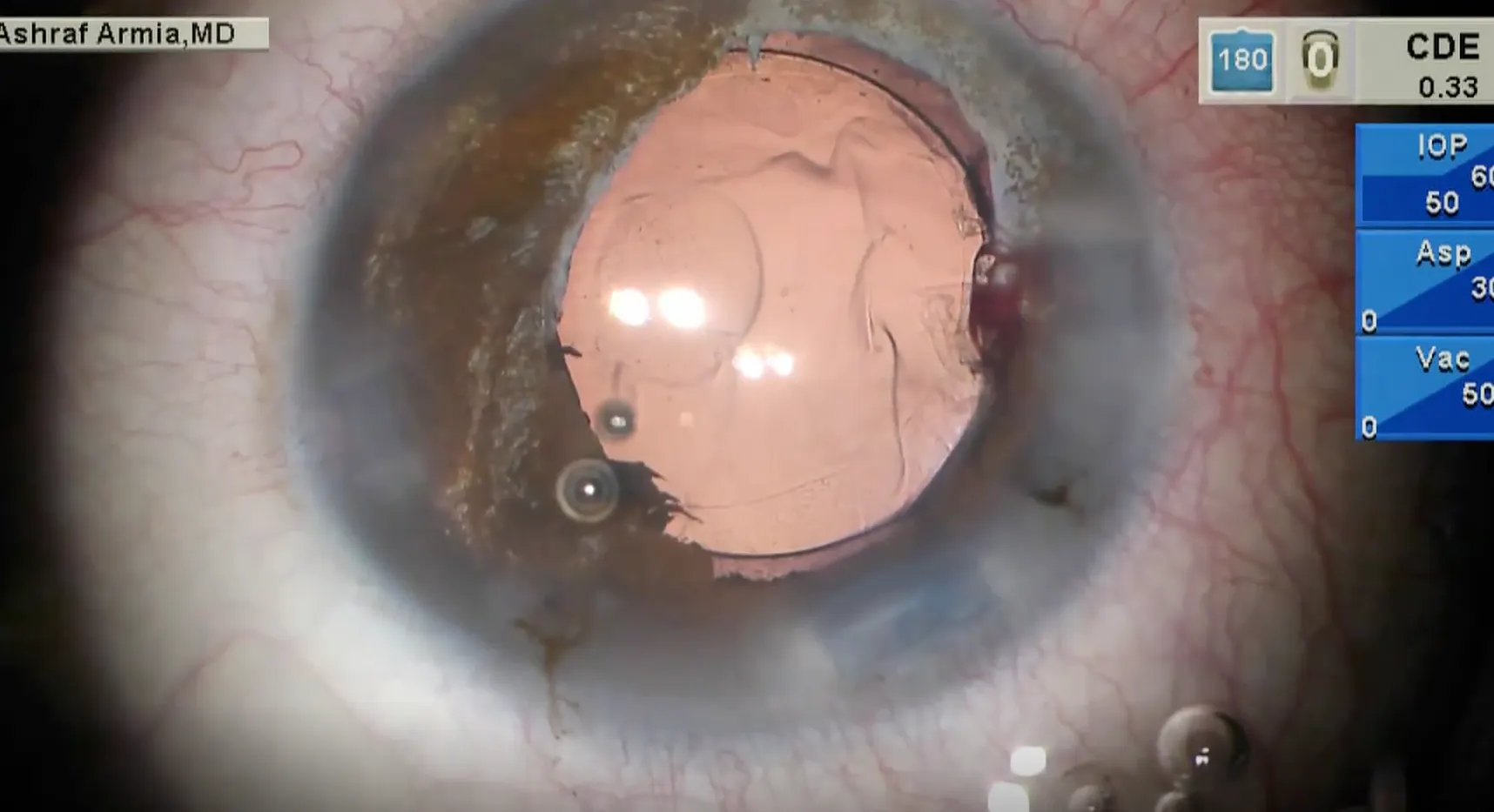 Iris Atrophy - Eyetube