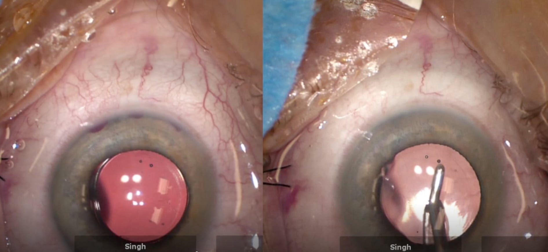 iStent infinite Fluid Wave - Eyetube