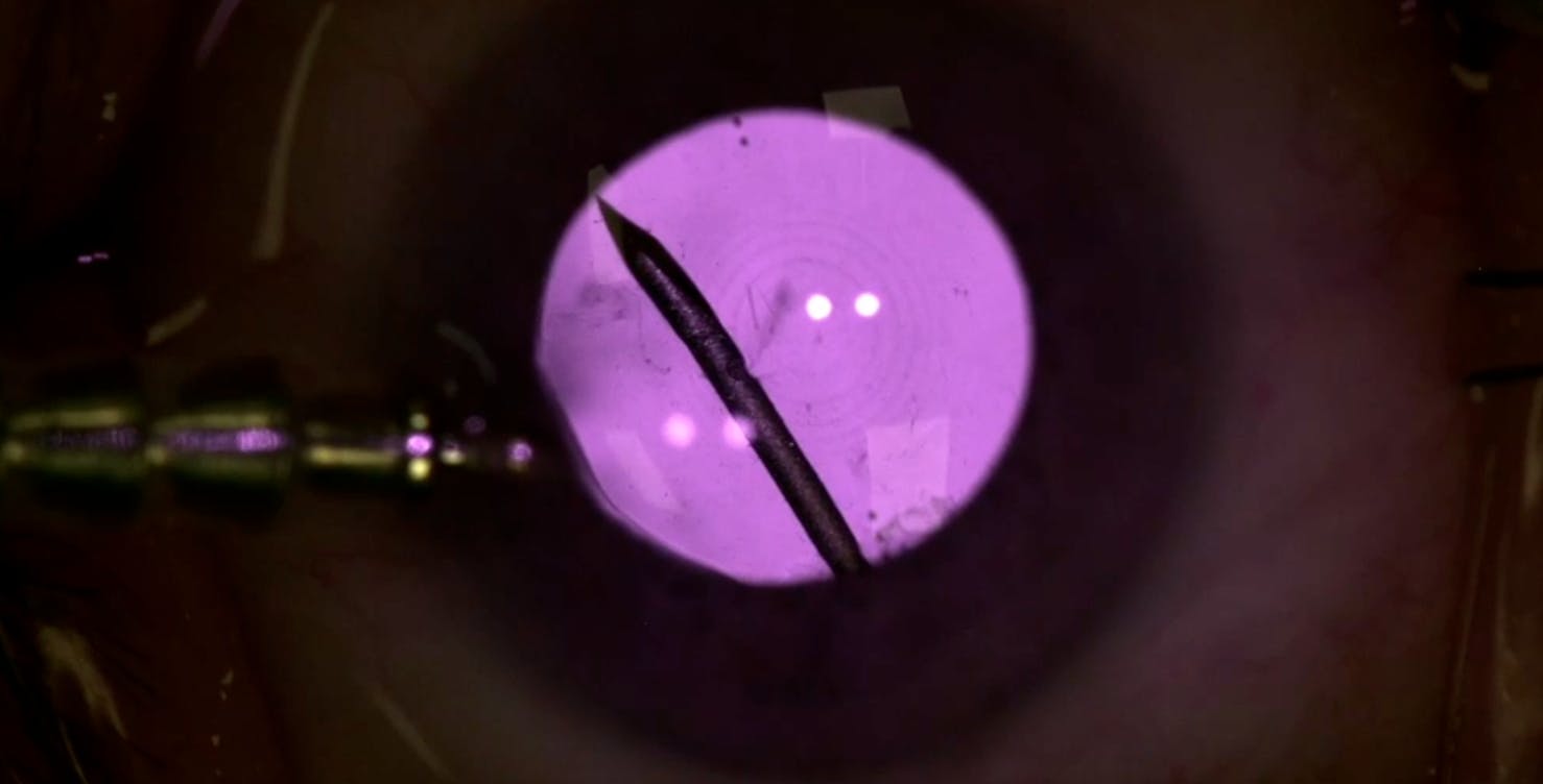 Visualizing the Vitreous With IR - Eyetube
