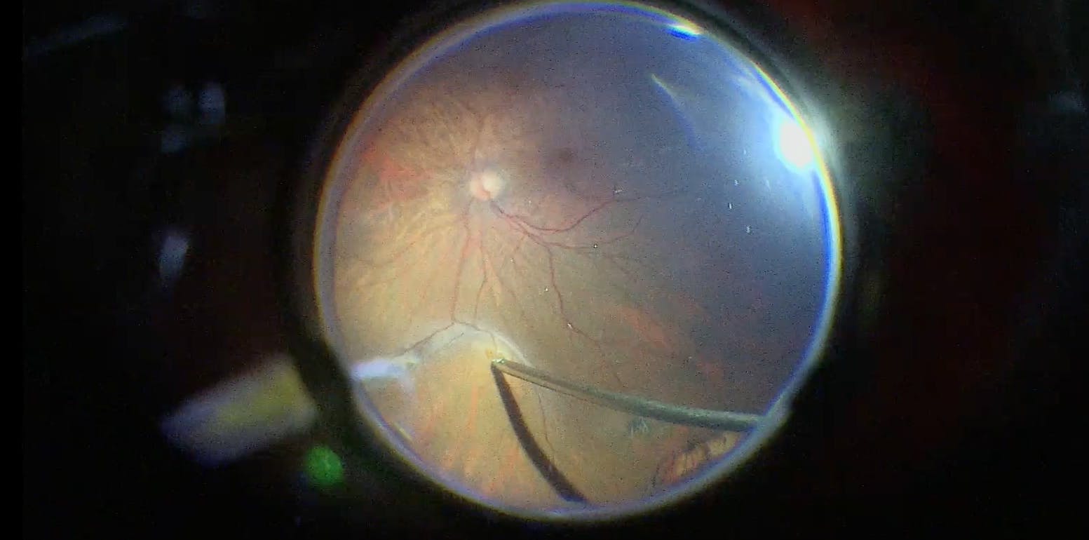 Complete Vitrectomy for Multiple Vitreoretinal Tractions - Eyetube