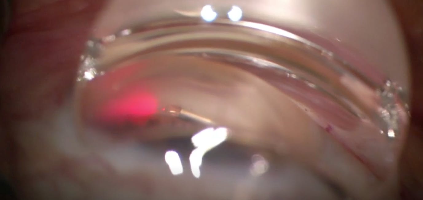 MIGS in Action: iTrack Canaloplasty and iStent Infinite - Eyetube