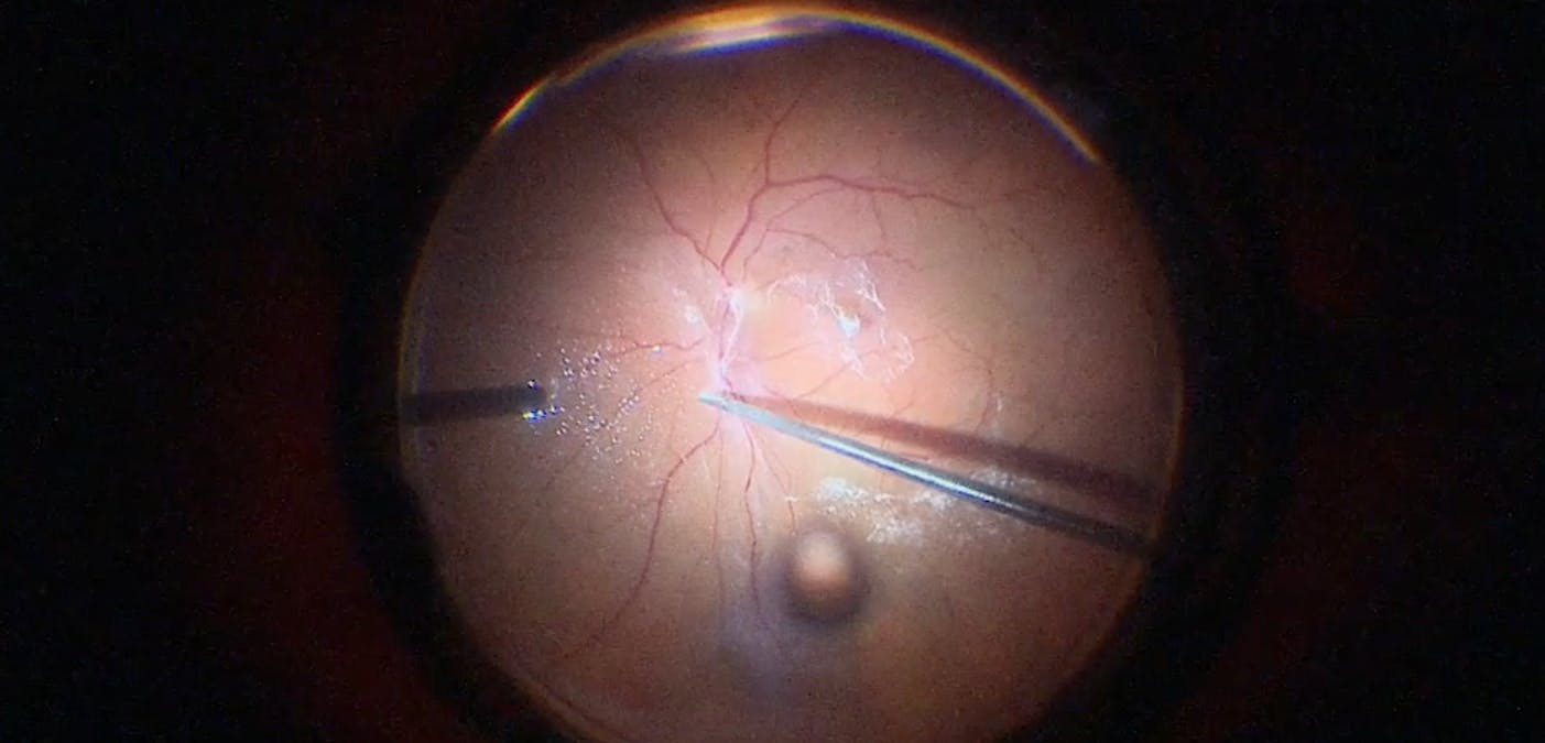 Severe Vitreoretinal Tractions and Retinal Detachment - Eyetube