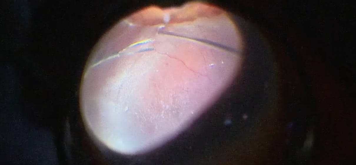 Long-Standing Retinal Detachment With PVR - Eyetube