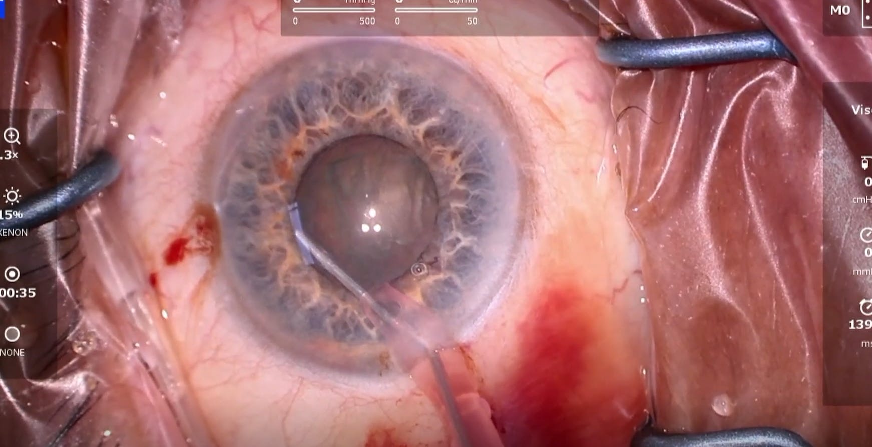 Sleeve Hydrodissection: Blocking Iris Prolapse in IFIS - Eyetube