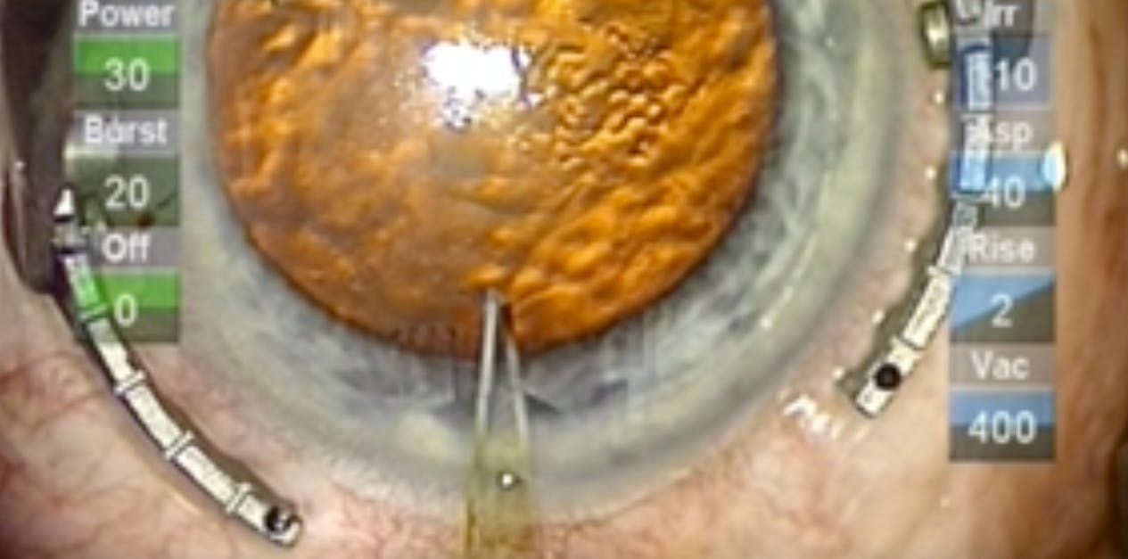 Incision Construction Using a Diamond Trapezoidal Blade - Eyetube