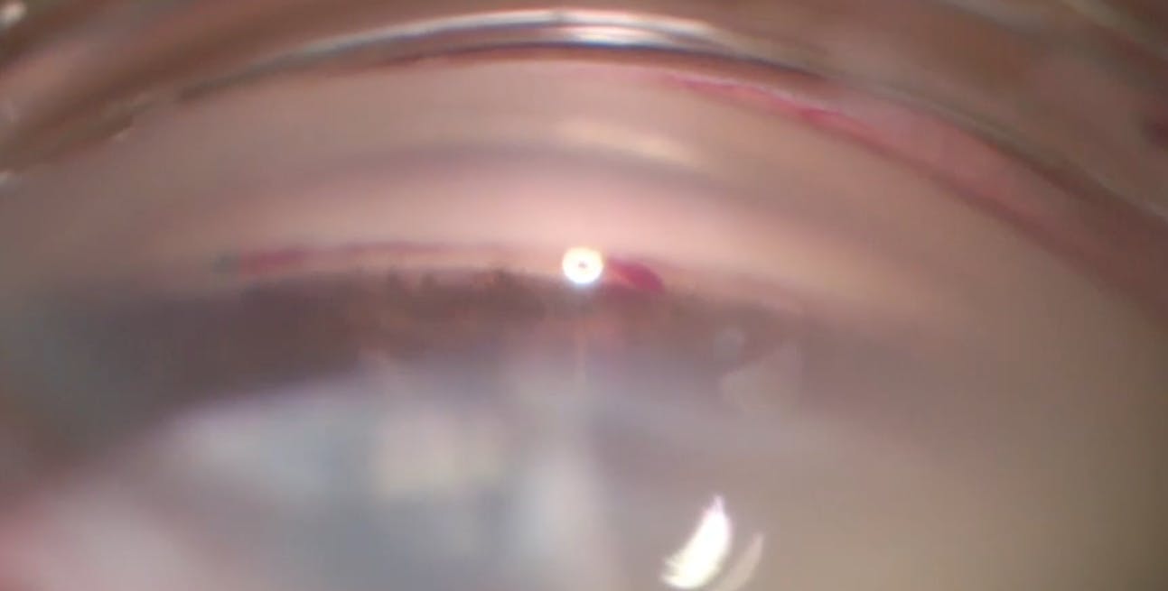 Interventional Glaucoma: iStent and iDose - Eyetube