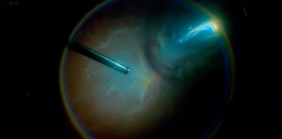 A Reshaping Transformative Vitrectomy for Advanced PVR - Eyetube