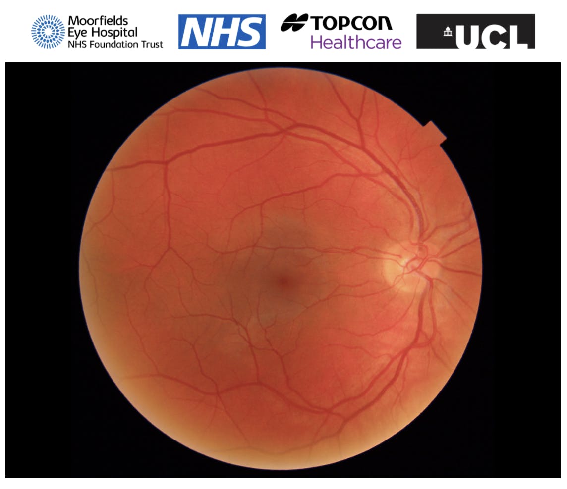 Moorfields Eye Hospital, UCL Institute of Ophthalmology and Topcon ...