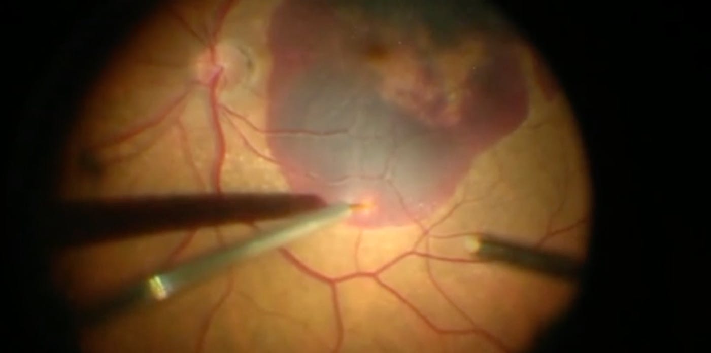 Subretinal tPA for Hemorrhage - Eyetube