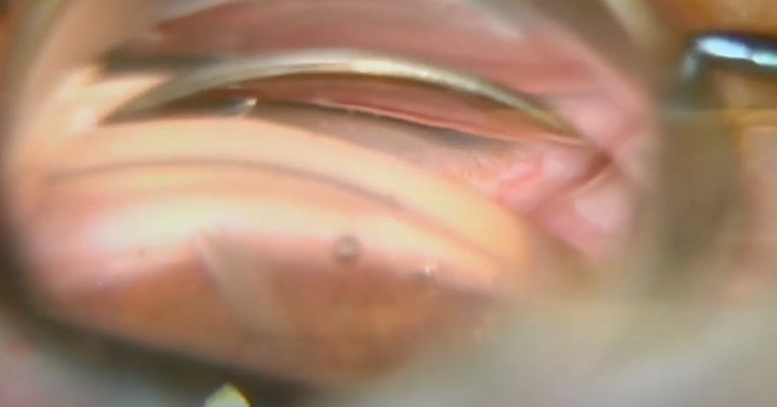 Pearls for iStent Infinite Placement - Eyetube