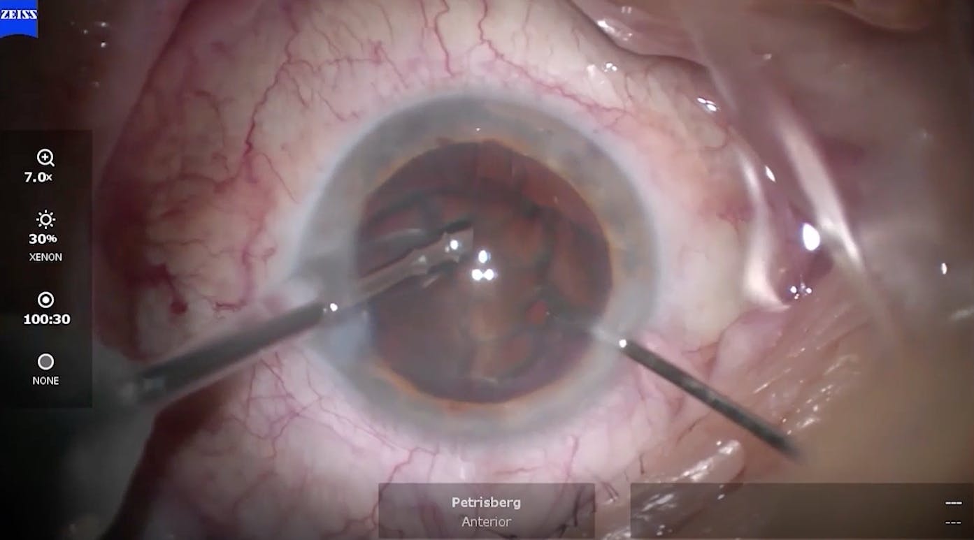 How to Deal With Capsular Ruptures - Eyetube