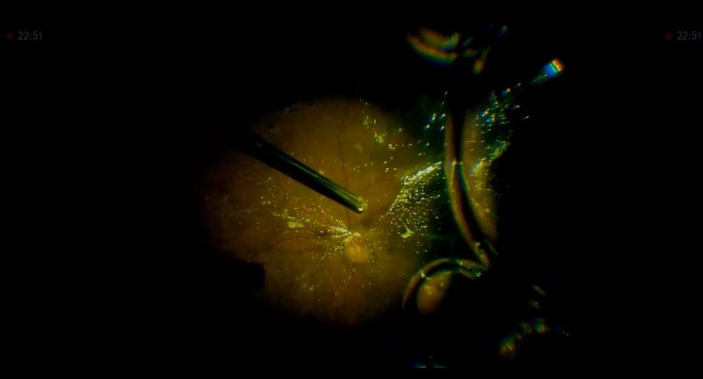 PDR and TRD With Fibrous Tissue Removal and Management of PVD and ...