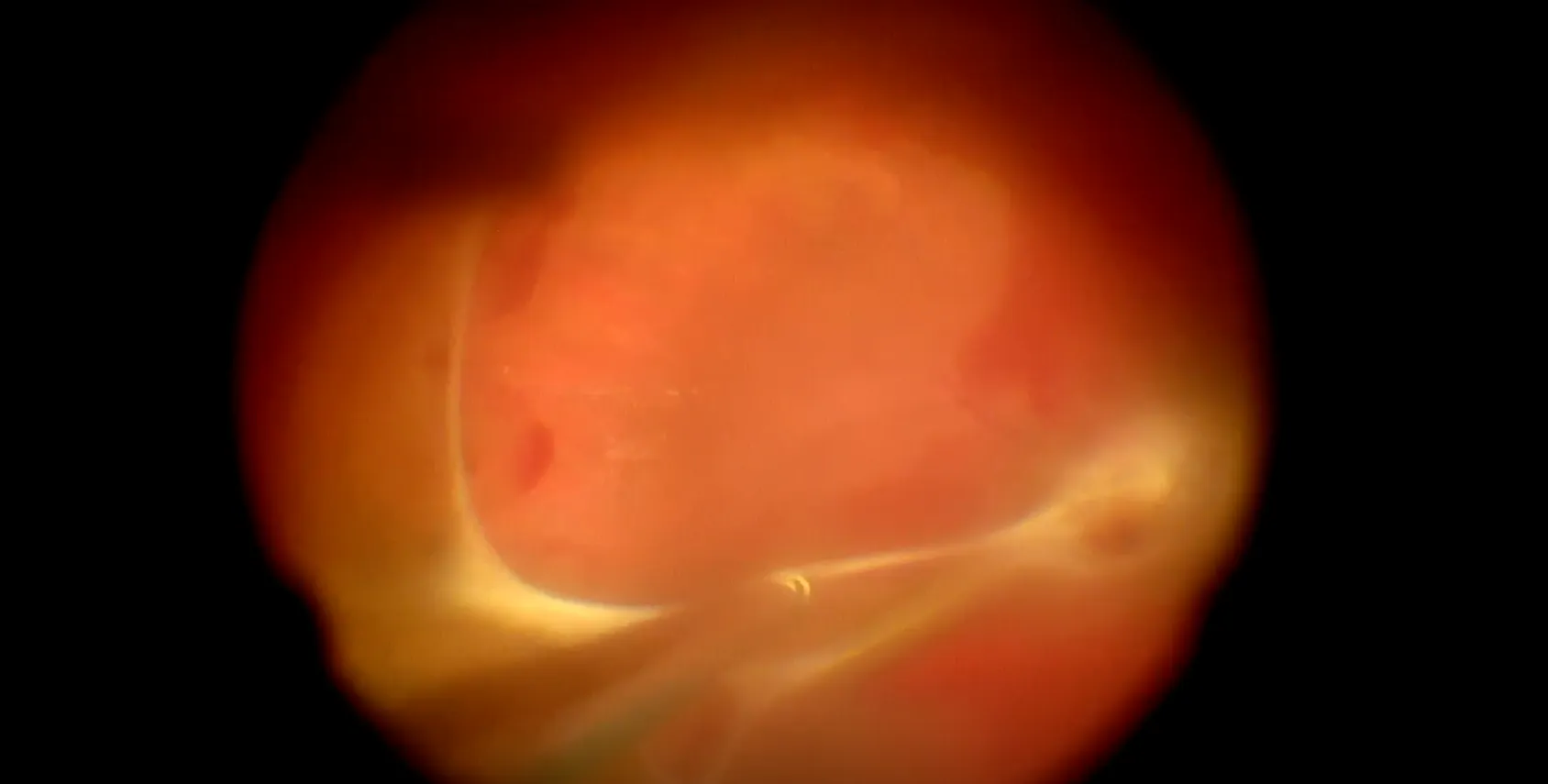 Vitrectomy for Tractional Retinal Detachment Associated With FEVR - Eyetube