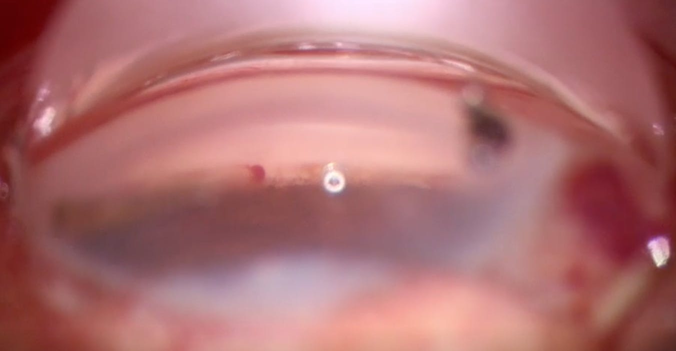 Interventional Glaucoma: iTrack Canaloplasty and iDose - Eyetube