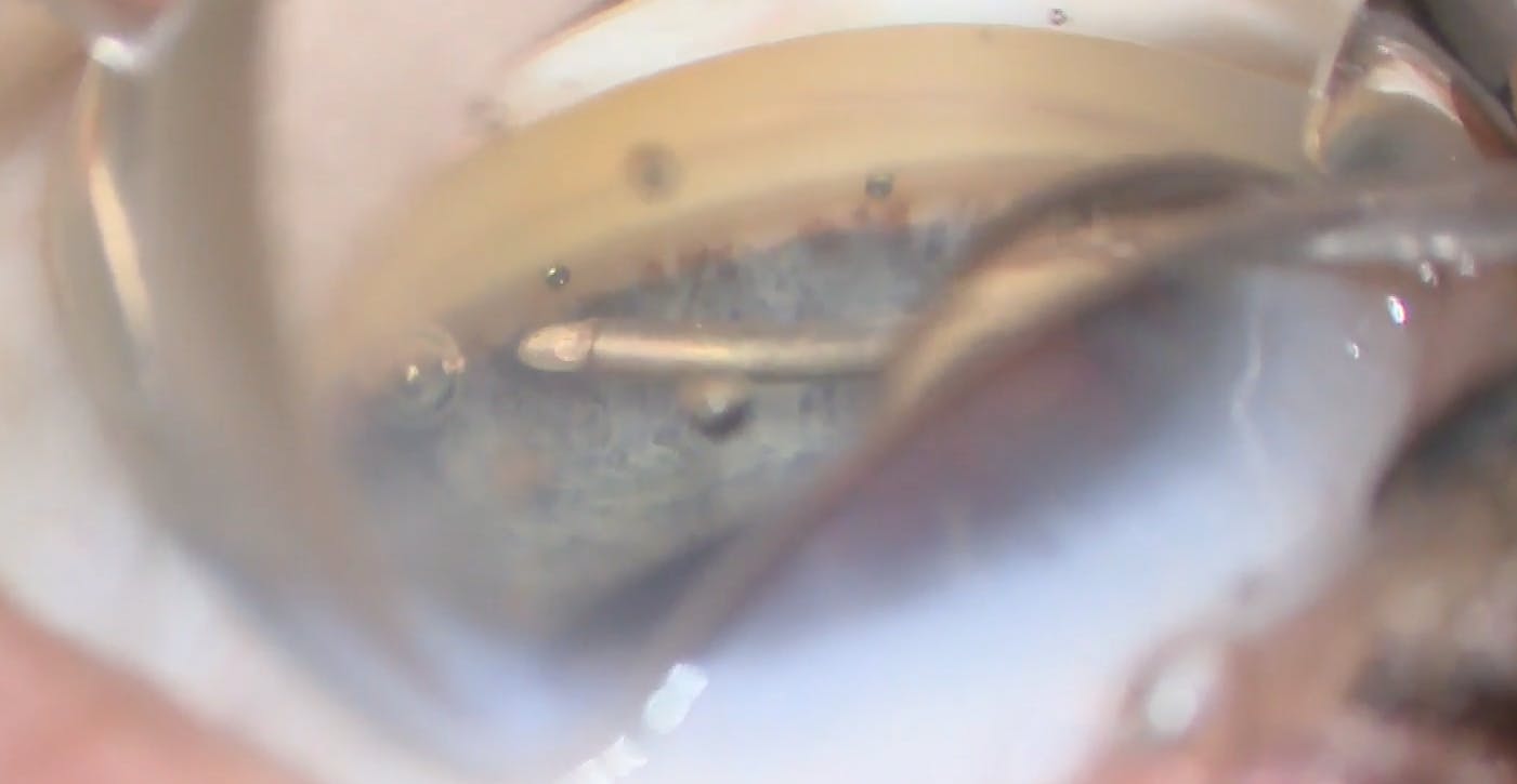 iTrack Advance: iStent Inject Preservation - Eyetube