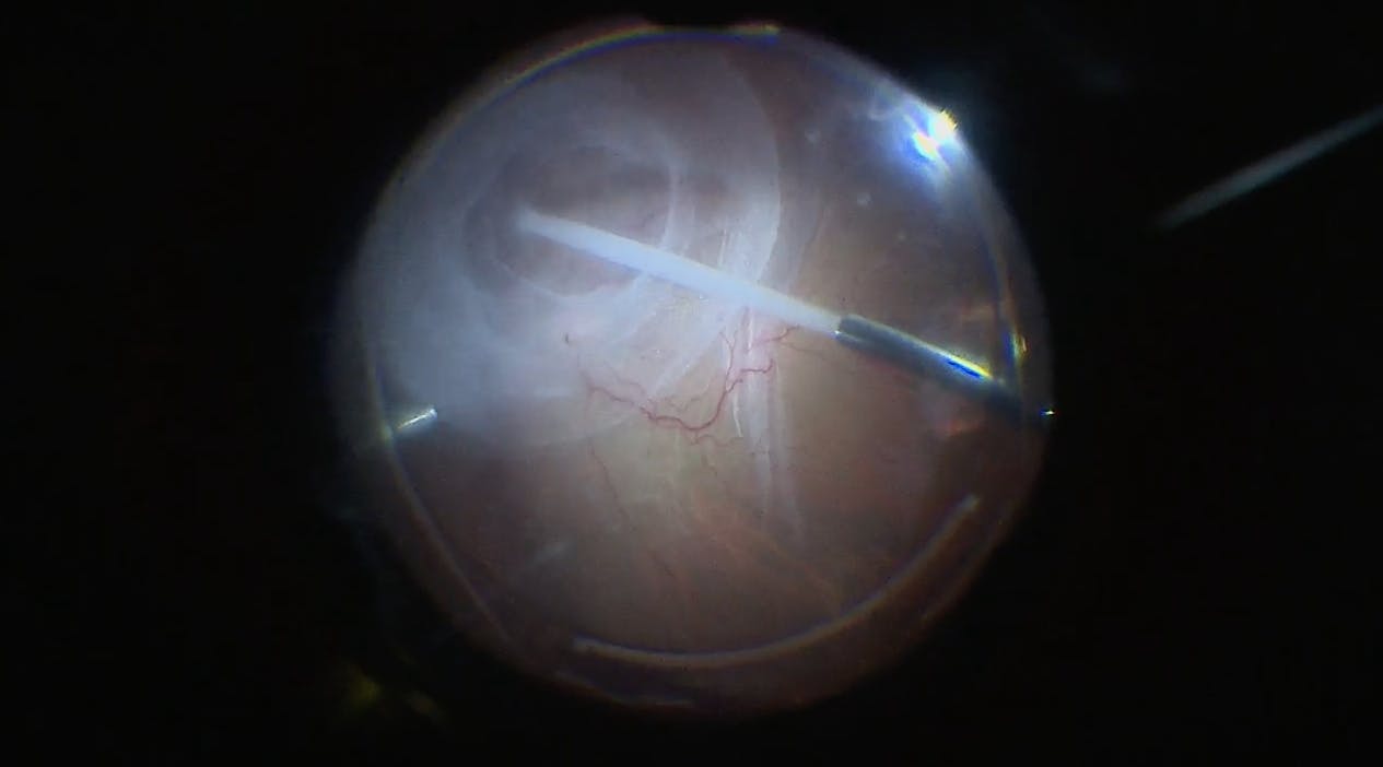 Secondary Detachment With Retinal Slippage - Eyetube