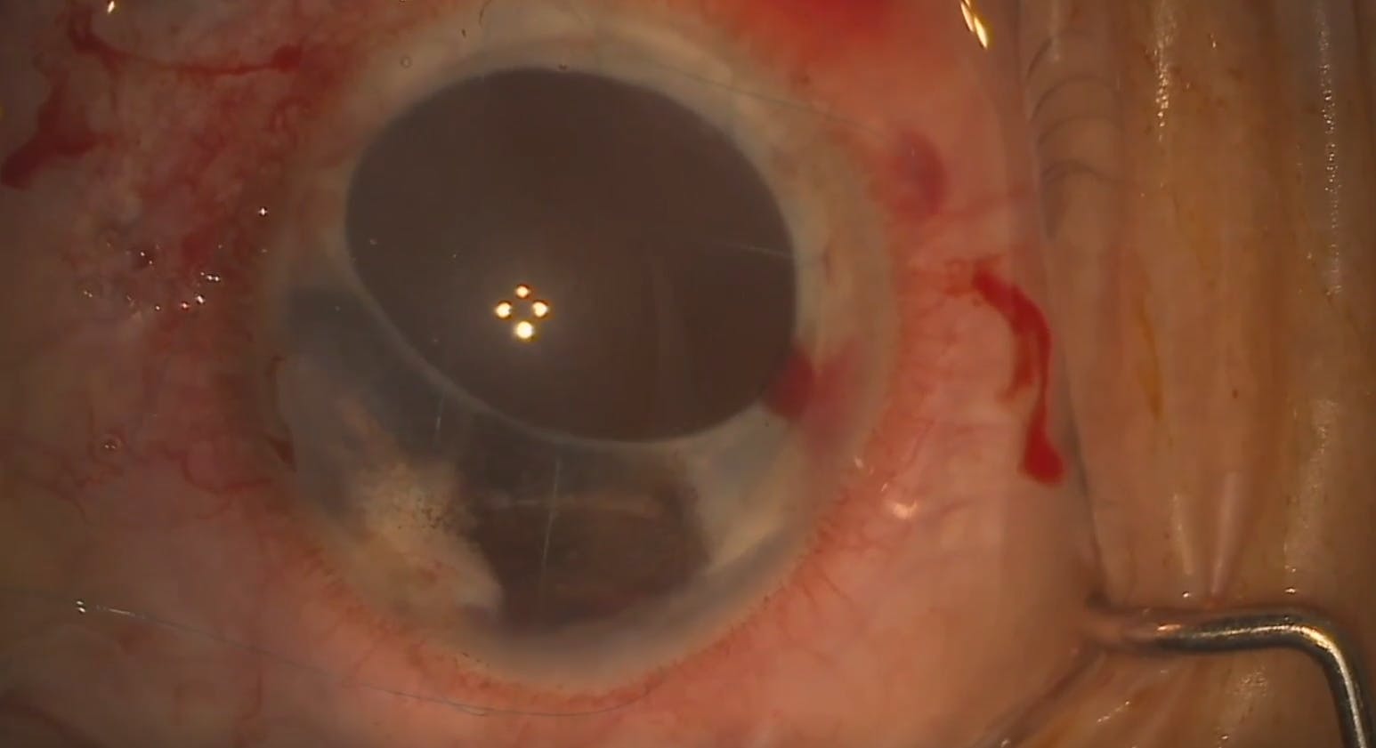 DMEK in Complex Eyes Part 1 - Eyetube