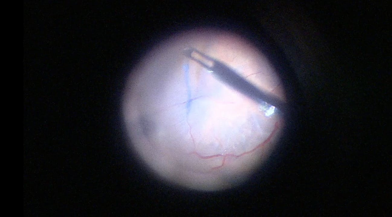Retinal Detachment With Subluxated Lens and Posterior PVR - Eyetube
