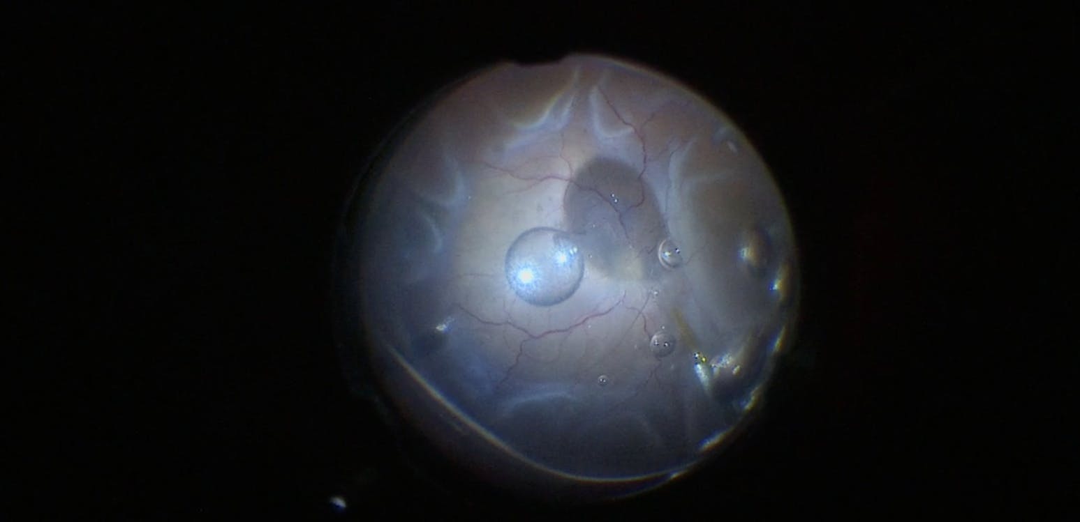 Triple Procedure for Bullous Retinal Detachment - Eyetube