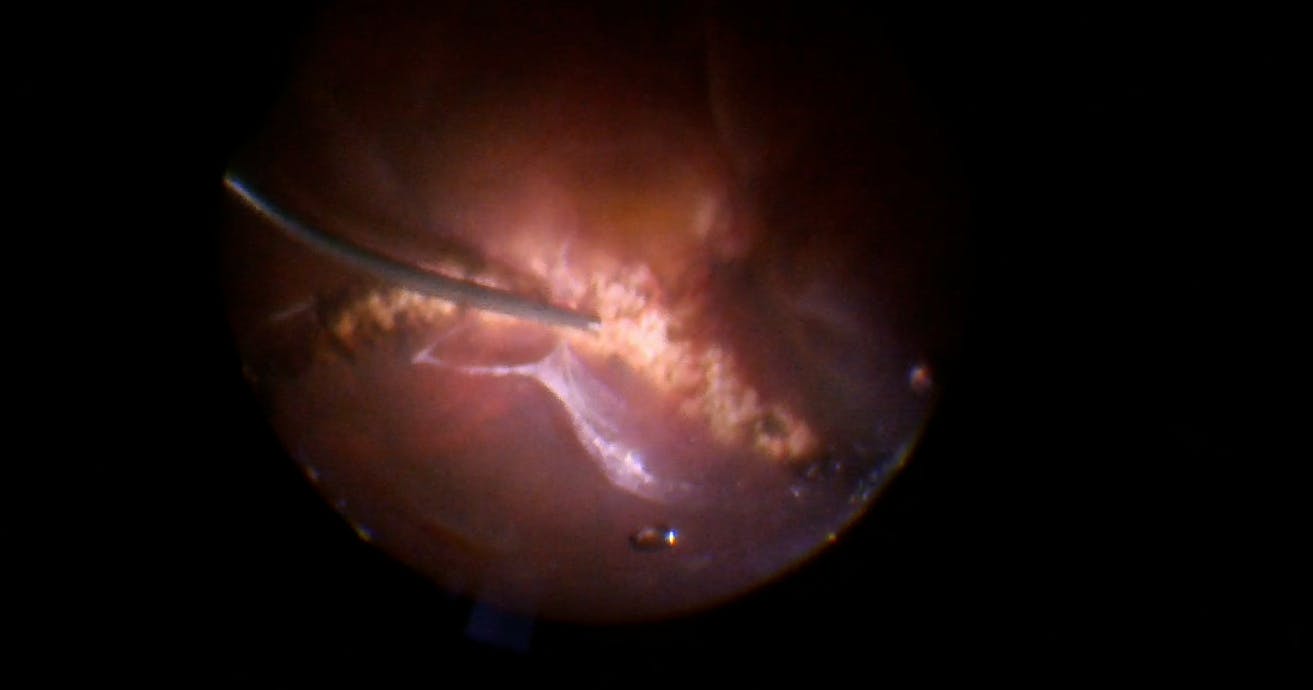 Highly Myopic Retinal Detachment With Crystalline Lens - Eyetube