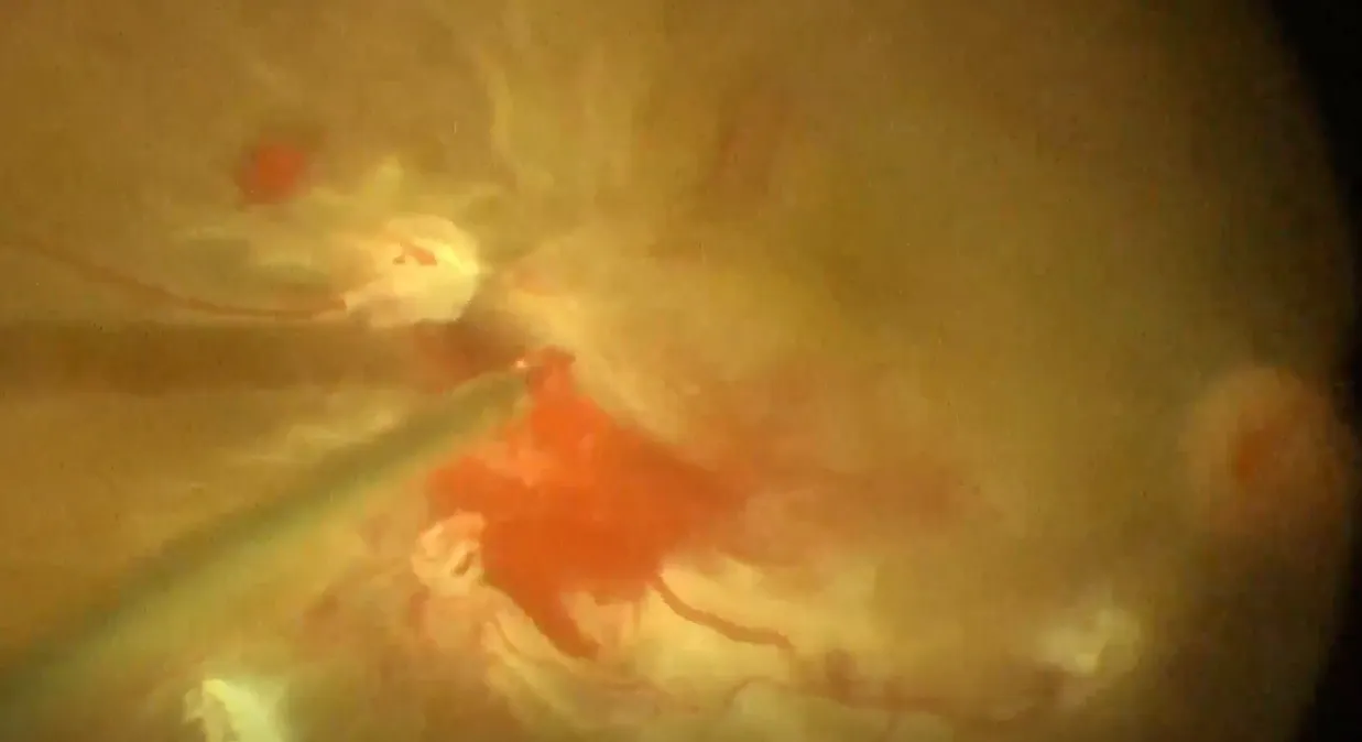 Tractional Retinal Detachment Repair: 25G Segmentation and Delaminating ...