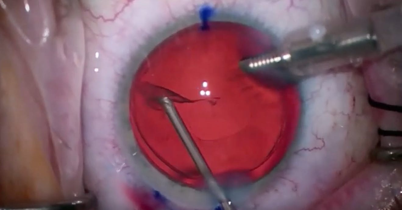 Extracapsular Lensectomy With Toric IOL Implantation for ...