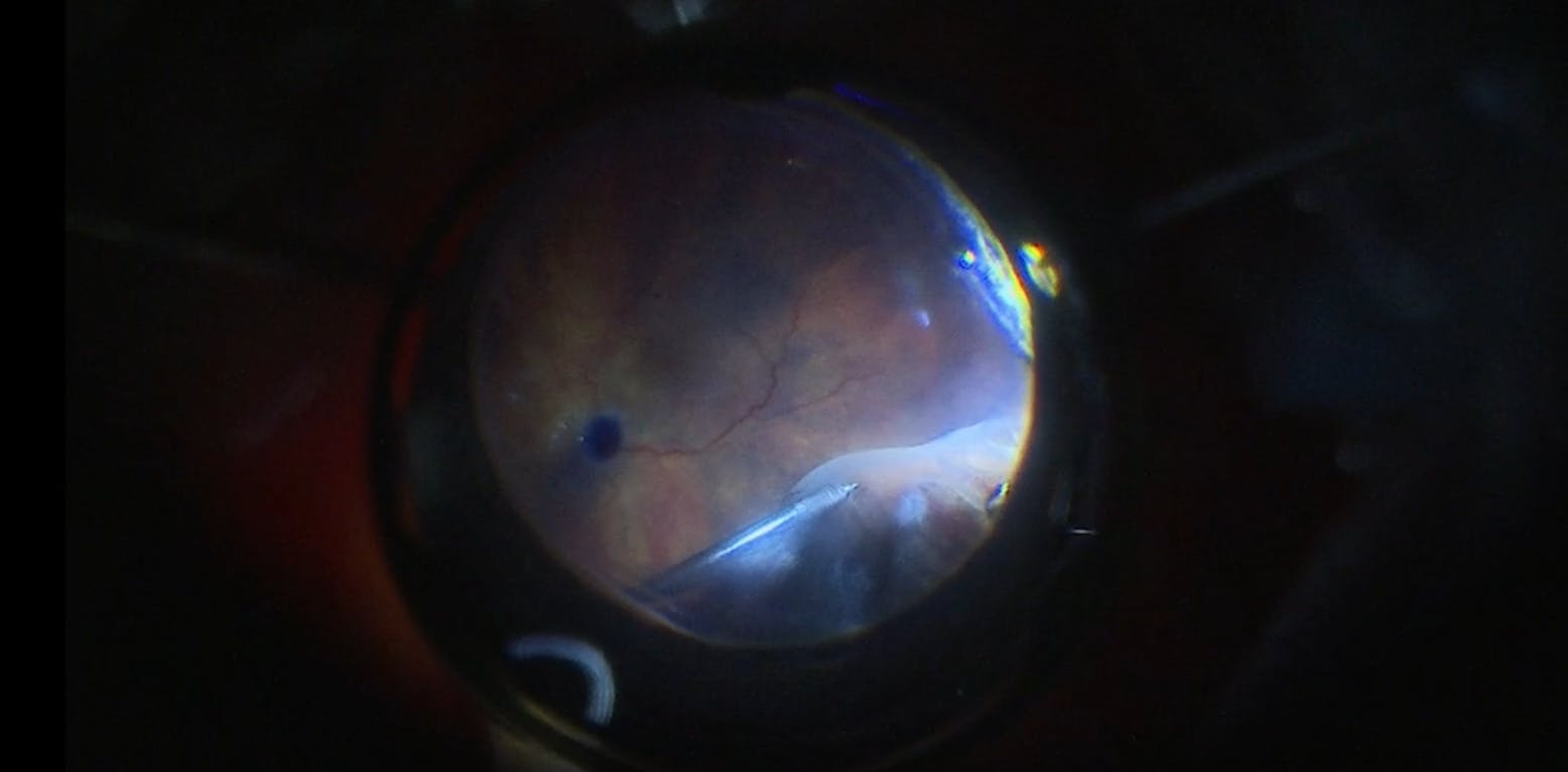 Pseudophakic Retinal Detachment With Posterior PVR - Eyetube