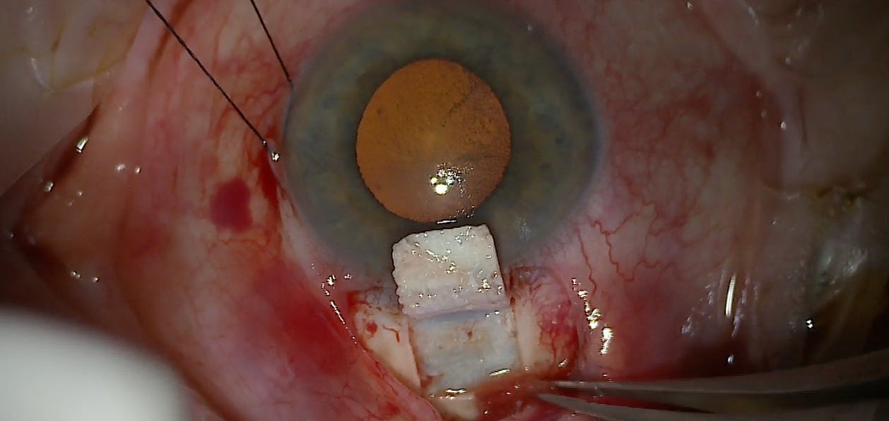 Combined Cataract and Non-Penetrating Deep Sclerectomy - Eyetube