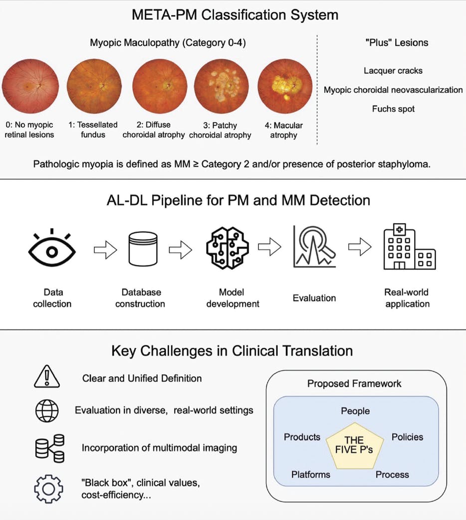 Using AI to Identify Pathologic Myopia and Myopic Maculopathy - Retina Today