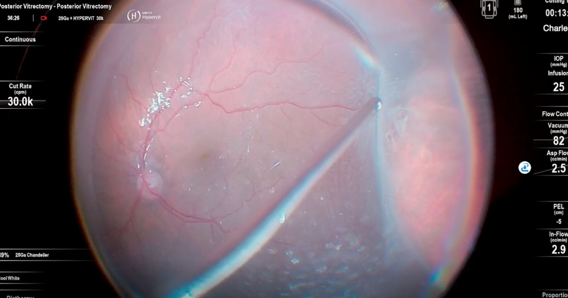 Retinal Detachment Repair With the Unity VCS Platform - Eyetube