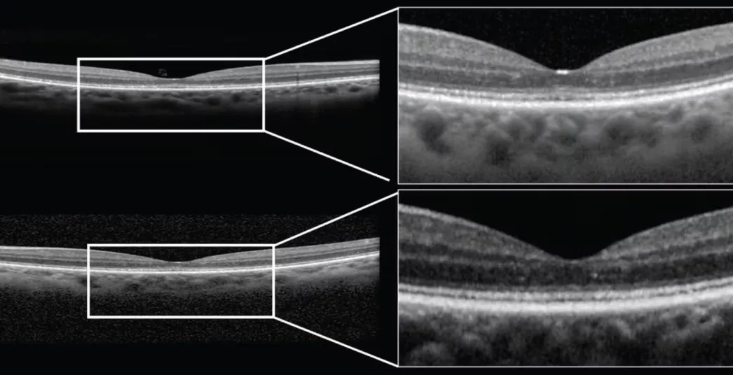 An OMD Retina Case - Retina Today
