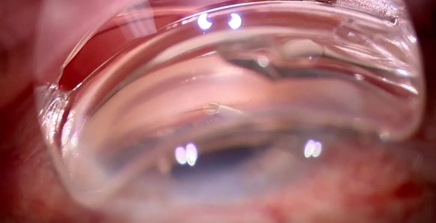 Standalone Interventional Glaucoma - Eyetube