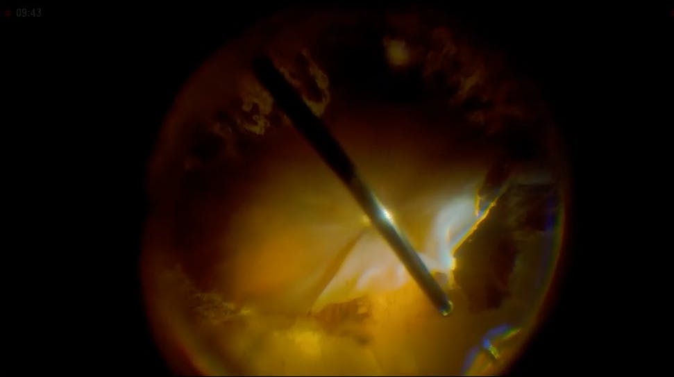 Navigating Complex Retinal Detachment, PVR, and Macula Involvement ...
