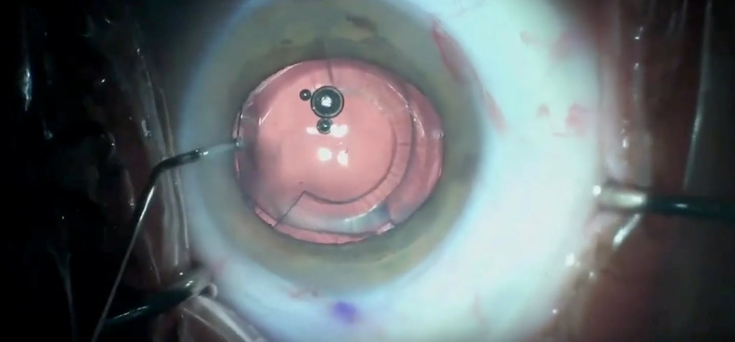 Pseudophakic Visual Rehabilitation: CTAK Followed by Piggyback ICL ...