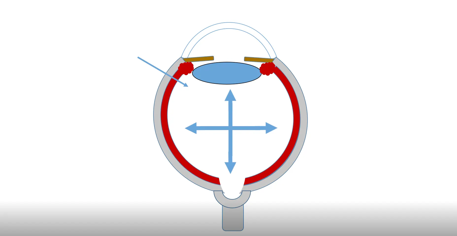 Optic Nerve Head Structural Changes After Intravitreal Injection - Eyetube