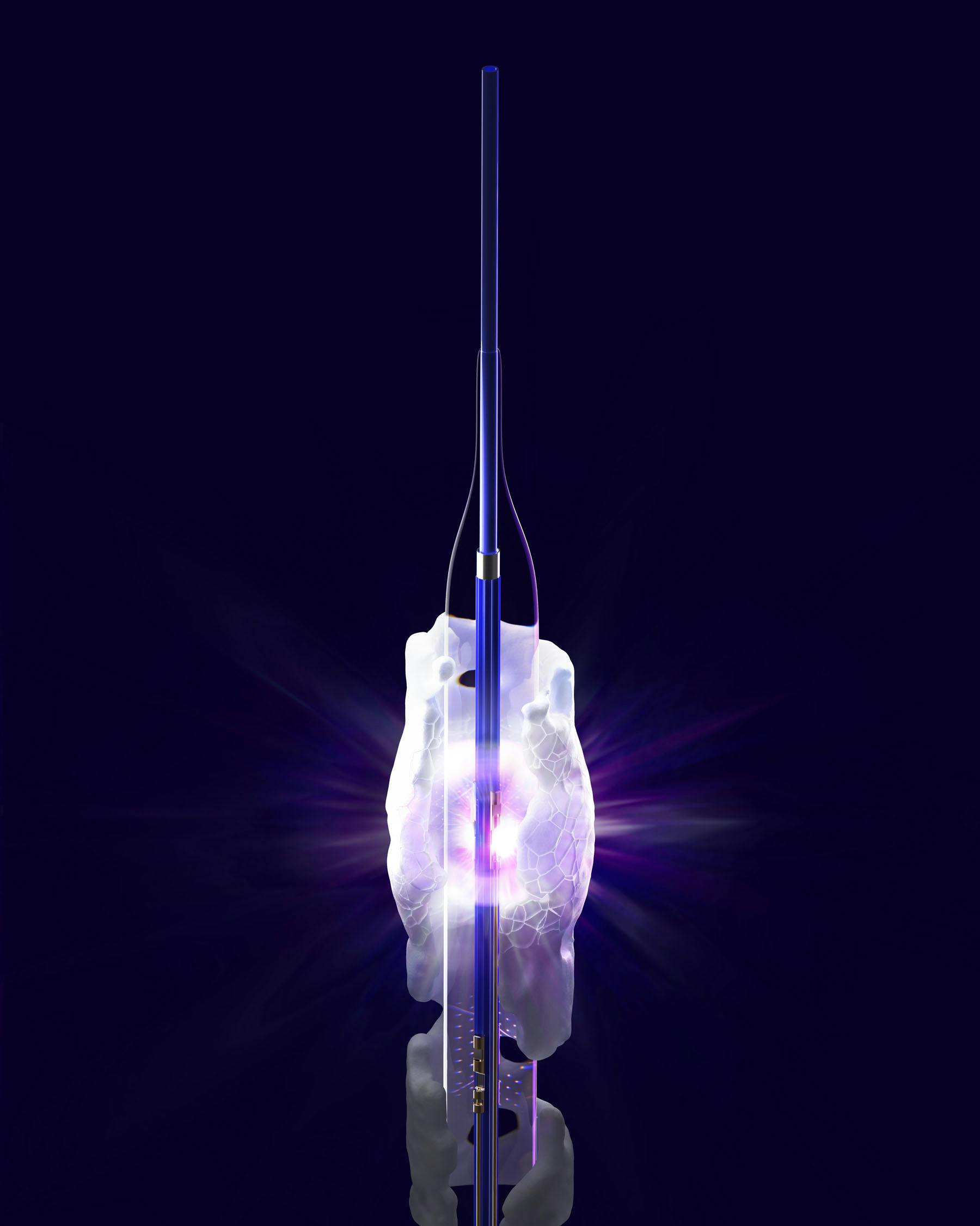 Boston Scientific’s Seismiq Peripheral IVL System Introduced in Limited ...