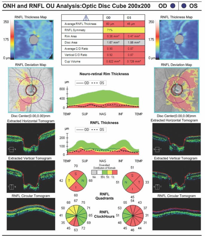 Combining Traditional Glaucoma Surgery With Drug Delivery - Glaucoma Today
