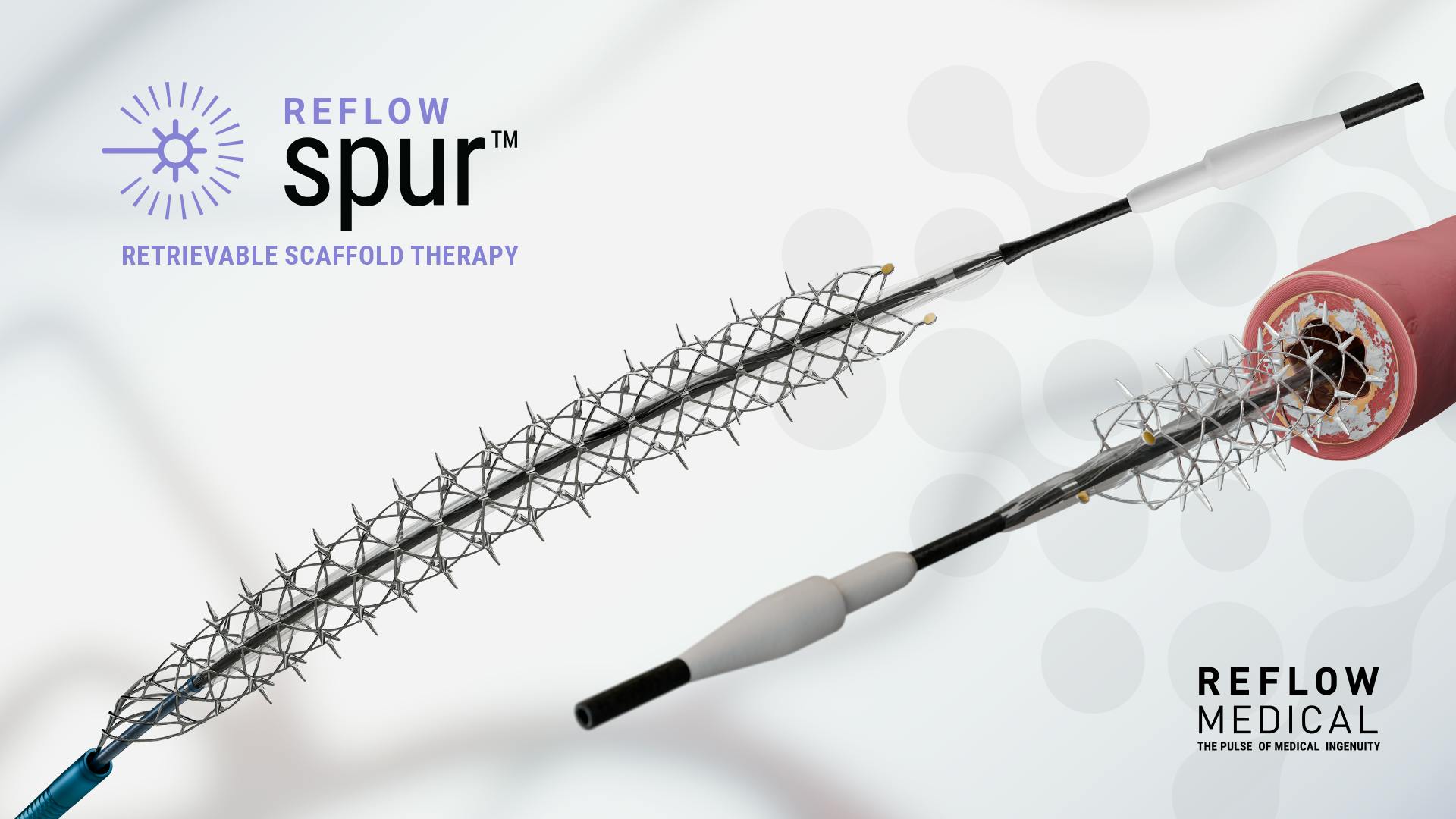 Reflow Spur’s DEEPER REVEAL Trial Completes Enrollment - Endovascular Today